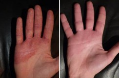 Photos before and after LED skin therapy | Mulberry House