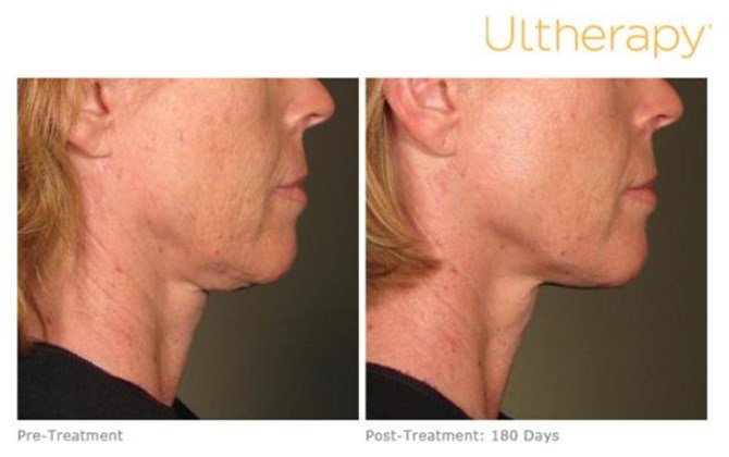 Ultherapy Before & After Photos | Mulberry House Clinic